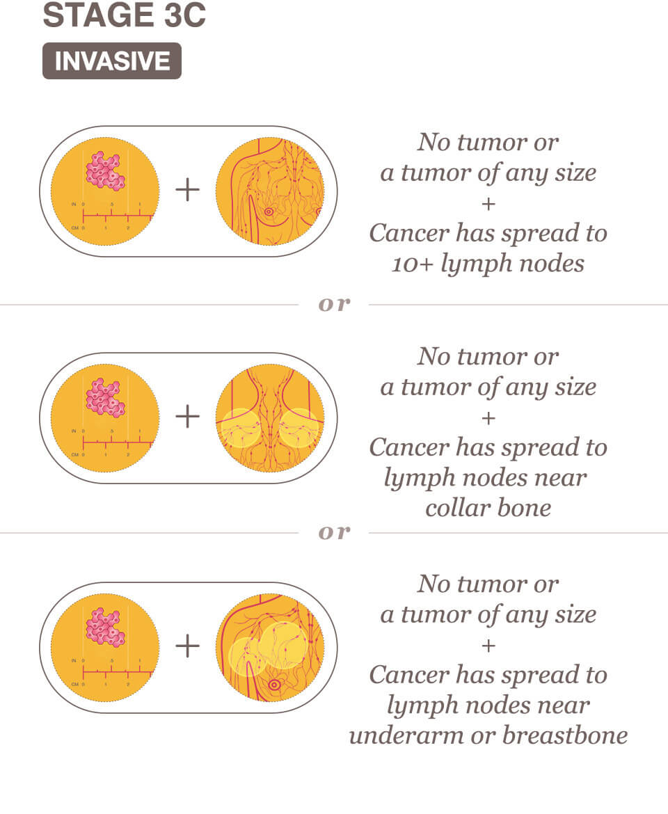 Stage 3 Breast Cancer Overview - National Breast Cancer Foundation